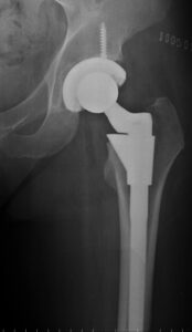 All About iovera° - Orthopedic Performance